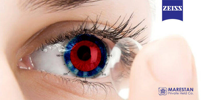 Calculation of TORIC IOL power in intraocular lenses - مارستان